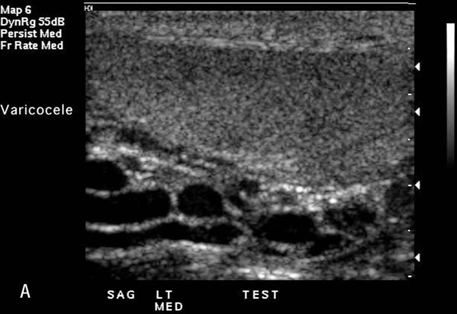 Varicocele – Sonographic Tendencies