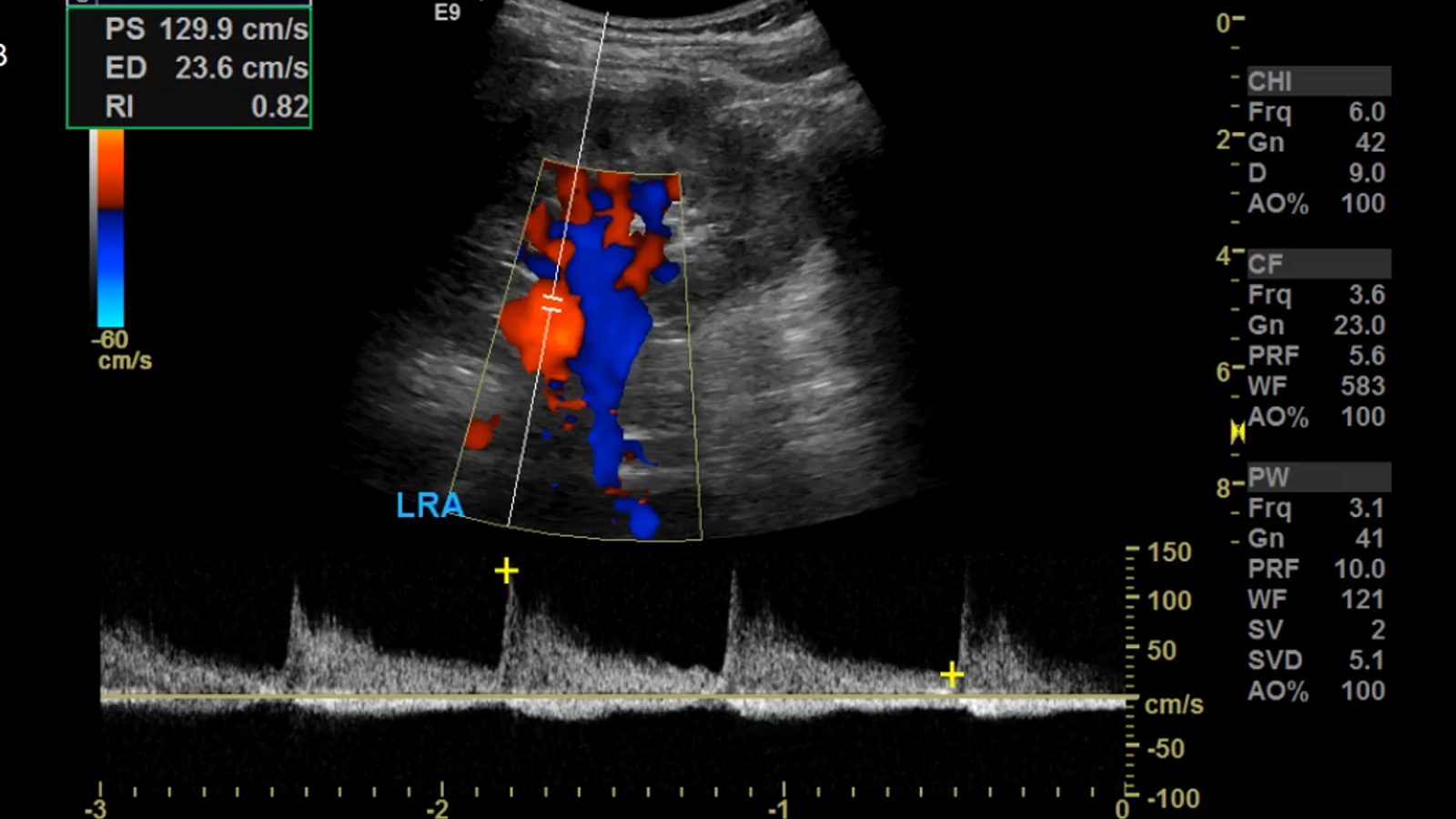 Renal Artery Anatomy Ultrasound Ultrasound Assessment Of Native Renal