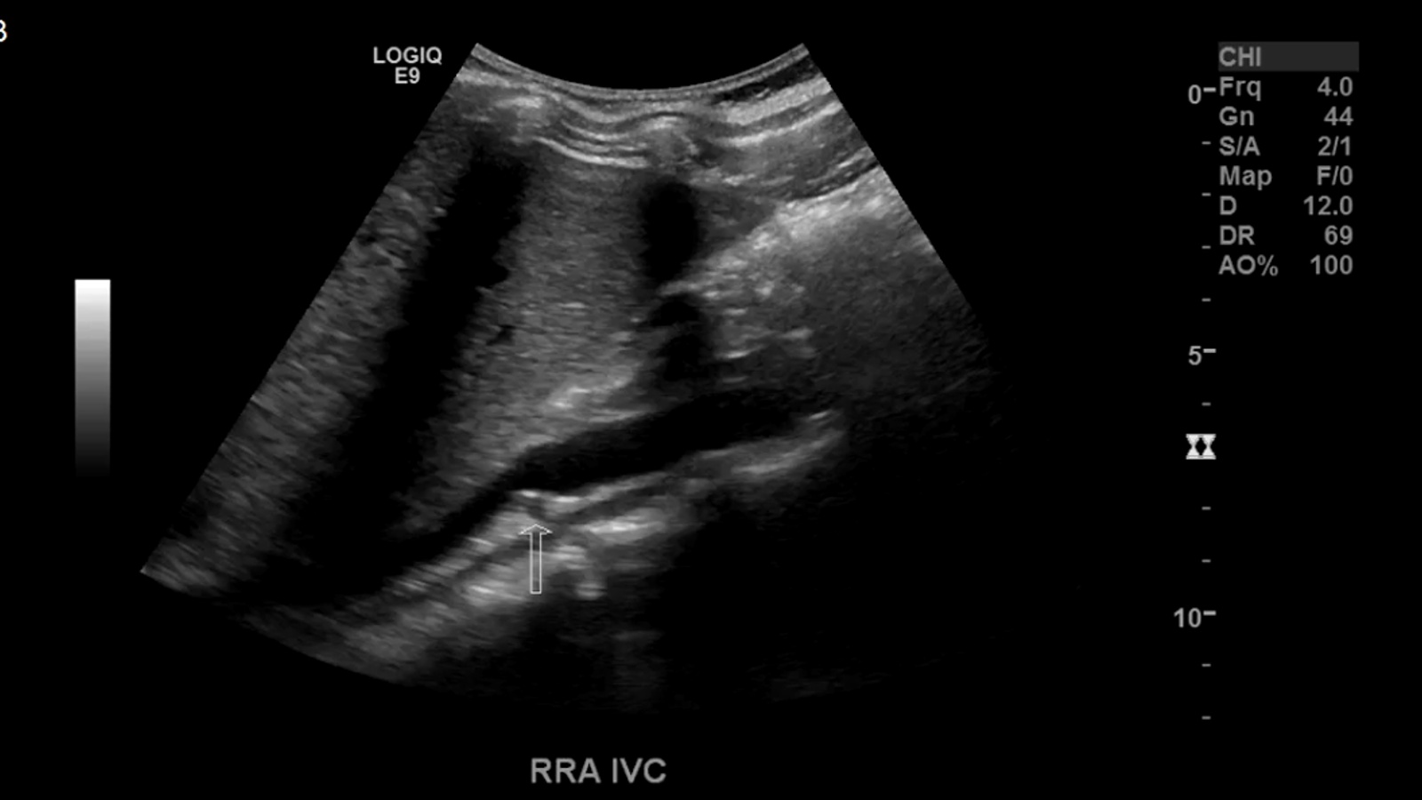 Renal Artery Doppler – Sonographic Tendencies