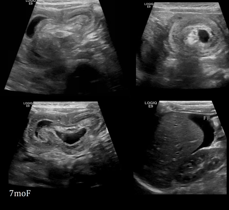 Intussusception – Sonographic Tendencies
