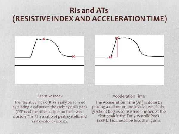 Renal Artery Doppler – Sonographic Tendencies