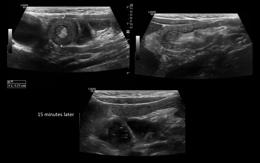 Intussusception – Sonographic Tendencies