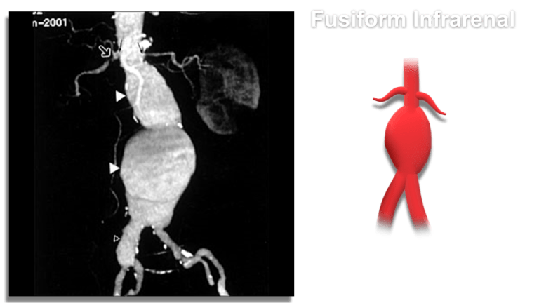 Abdominal Aortic Aneurysm – Sonographic Tendencies