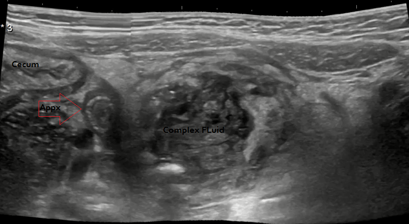 Appendix Ultrasound – Sonographic Tendencies