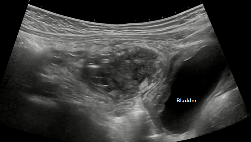 Appendix Ultrasound – Sonographic Tendencies