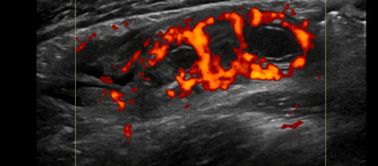 Appendix Ultrasound – Sonographic Tendencies