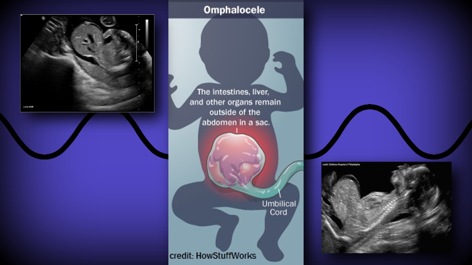 Omphalocele vs. Gastroschisis – Sonographic Tendencies