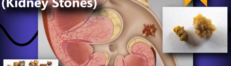 Nephrolithiasis (Kidney Stones) – Sonographic Tendencies