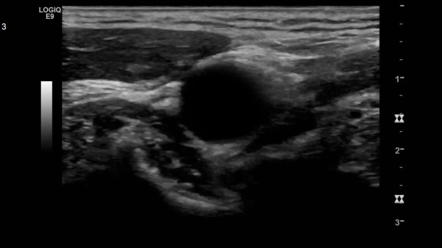 Carotid Duplex Sonographic Tendencies