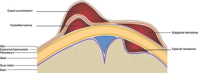 Subgaleal Hematoma – Sonographic Tendencies