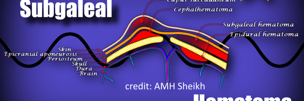 cephalohematoma – Sonographic Tendencies