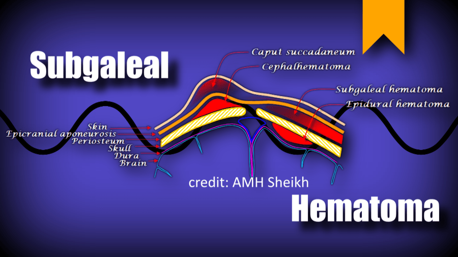 Subgaleal Hematoma – Sonographic Tendencies