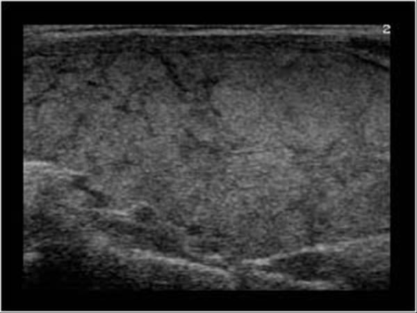 Thyroid Ultrasound – Sonographic Tendencies
