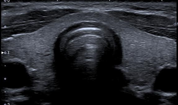 Thyroid Ultrasound – Sonographic Tendencies