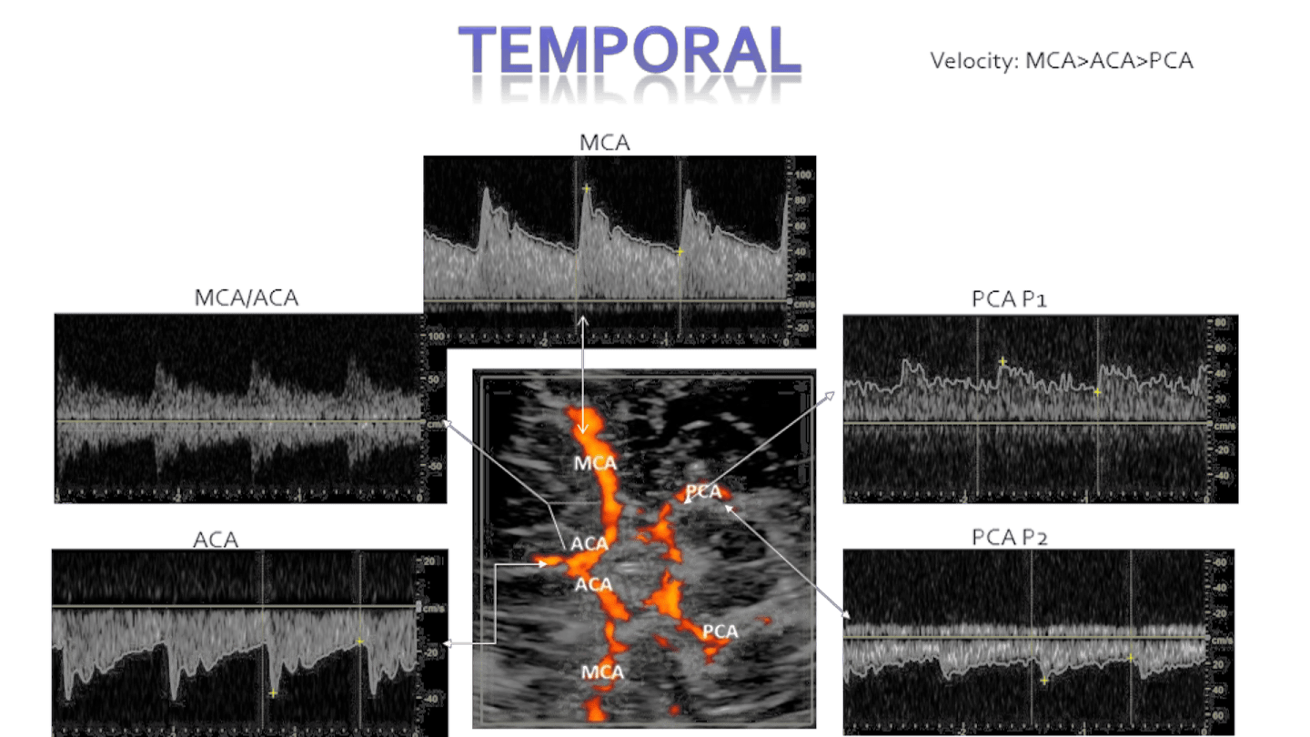 Transcranial Doppler – Sonographic Tendencies