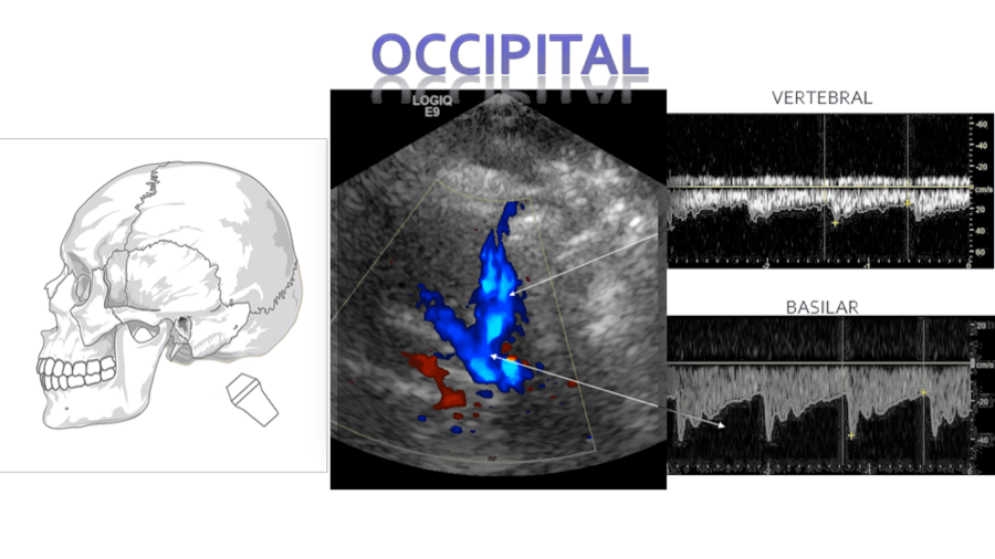 Transcranial Doppler – Sonographic Tendencies