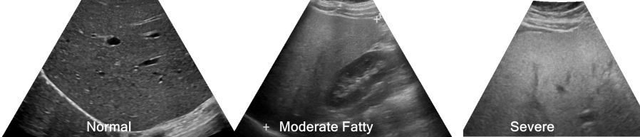 Hepatic Steatosis (Fatty Liver) – Sonographic Tendencies
