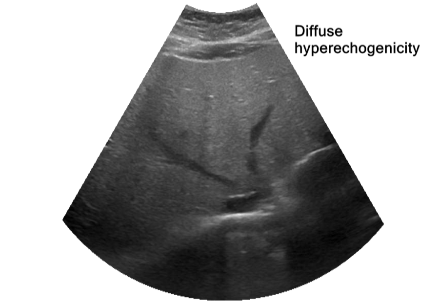 Hepatic Steatosis (Fatty Liver) – Sonographic Tendencies