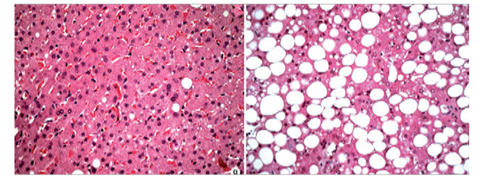 Hepatic Steatosis (Fatty Liver) – Sonographic Tendencies