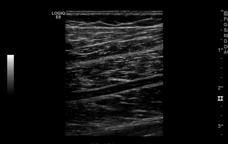 Arterial Doppler/Duplex of the Lower Extremities – Sonographic Tendencies