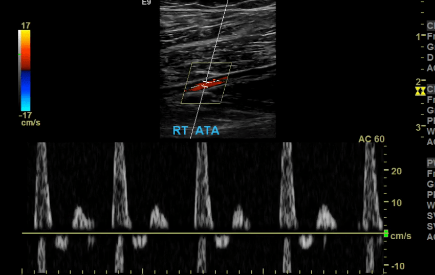 Arterial Doppler/Duplex of the Lower Extremities – Sonographic Tendencies