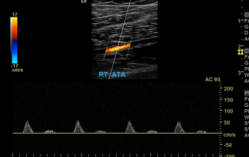 Arterial Doppler/Duplex of the Lower Extremities – Sonographic Tendencies
