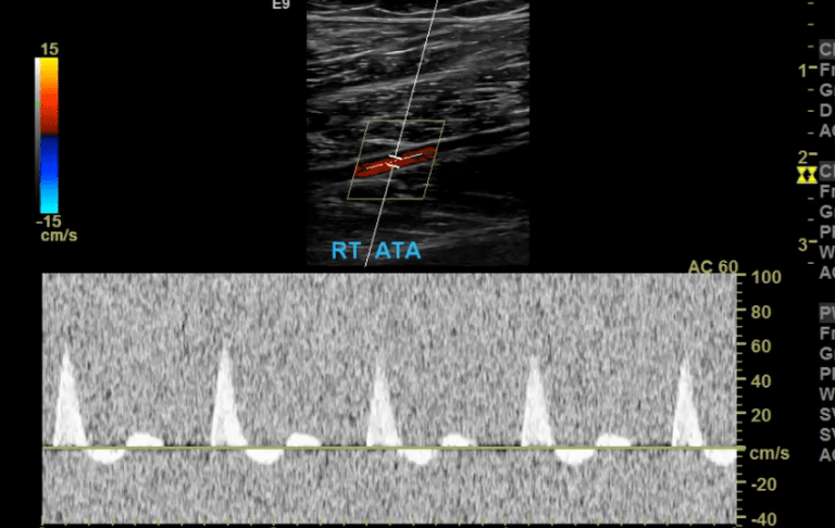 Arterial Doppler/Duplex of the Lower Extremities – Sonographic Tendencies