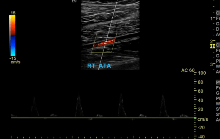 Arterial Doppler/Duplex of the Lower Extremities – Sonographic Tendencies