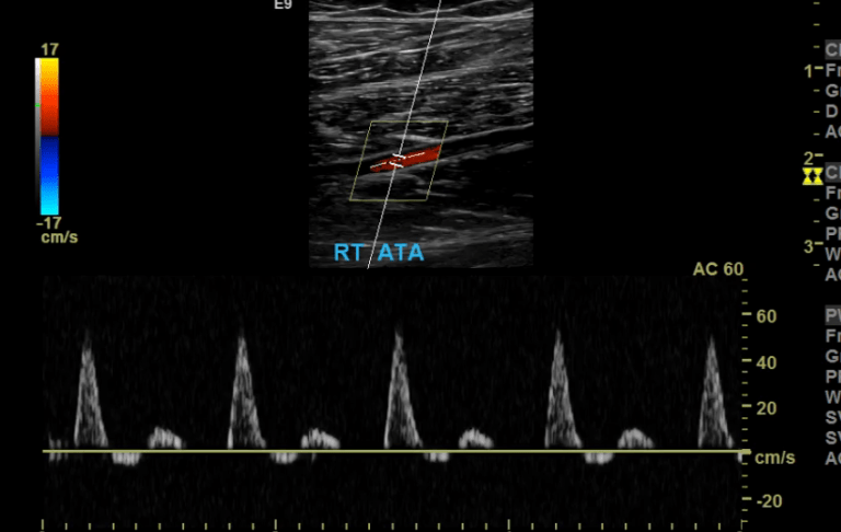 Arterial Doppler/Duplex of the Lower Extremities – Sonographic Tendencies