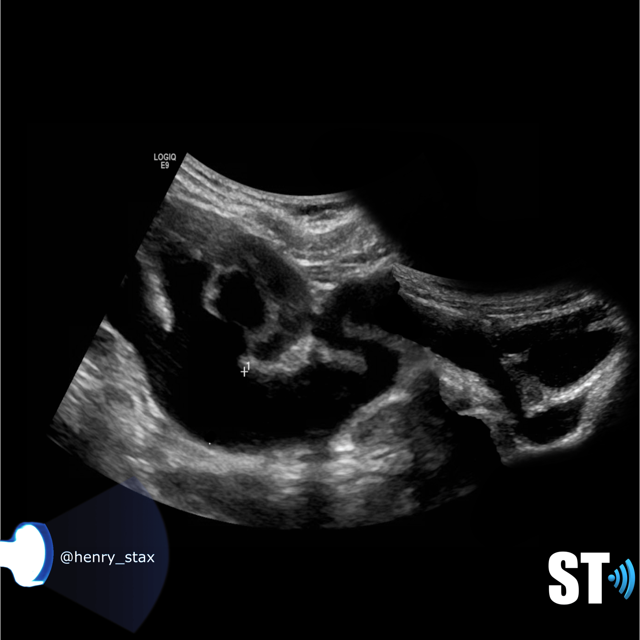 Renal Pathology – Sonographic Tendencies