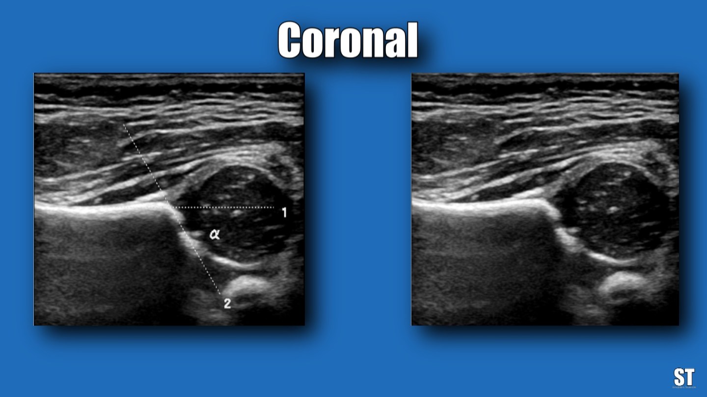 Neonatal Hip Ultrasound – Sonographic Tendencies