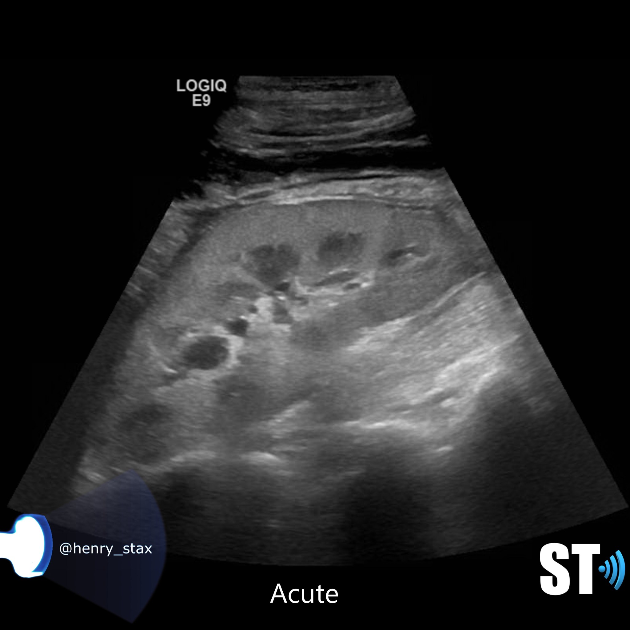 Renal Pathology – Sonographic Tendencies