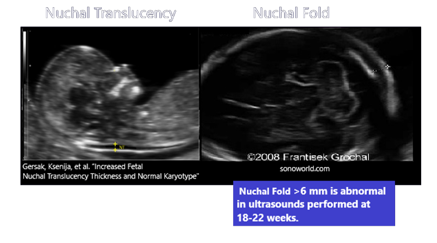 OB Ultrasound Second Trimester (The Basics) – Sonographic Tendencies