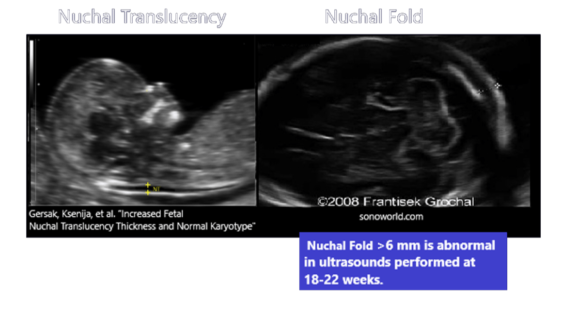 OB Ultrasound Second Trimester (The Basics) – Sonographic Tendencies