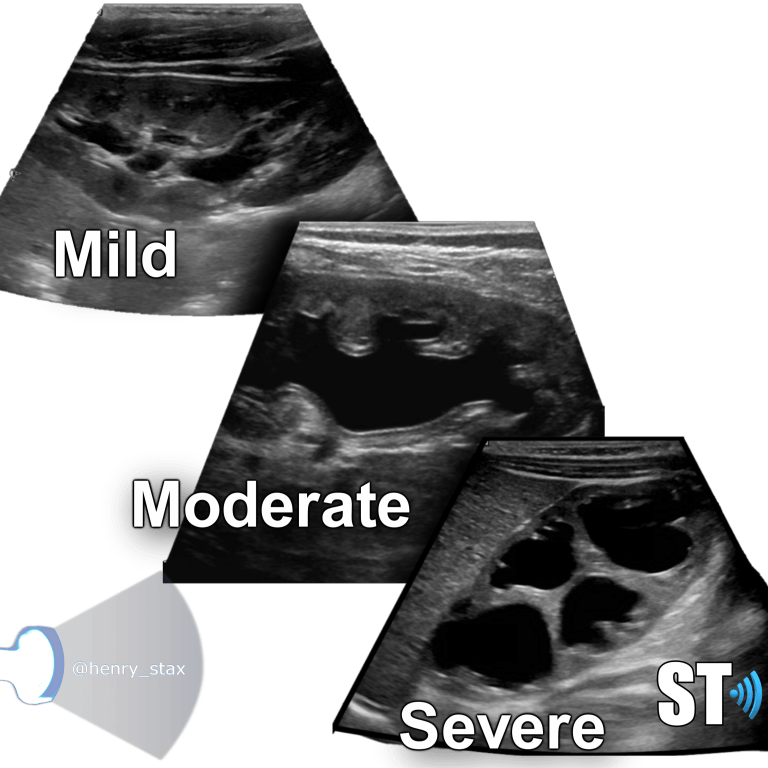 Renal Pathology – Sonographic Tendencies
