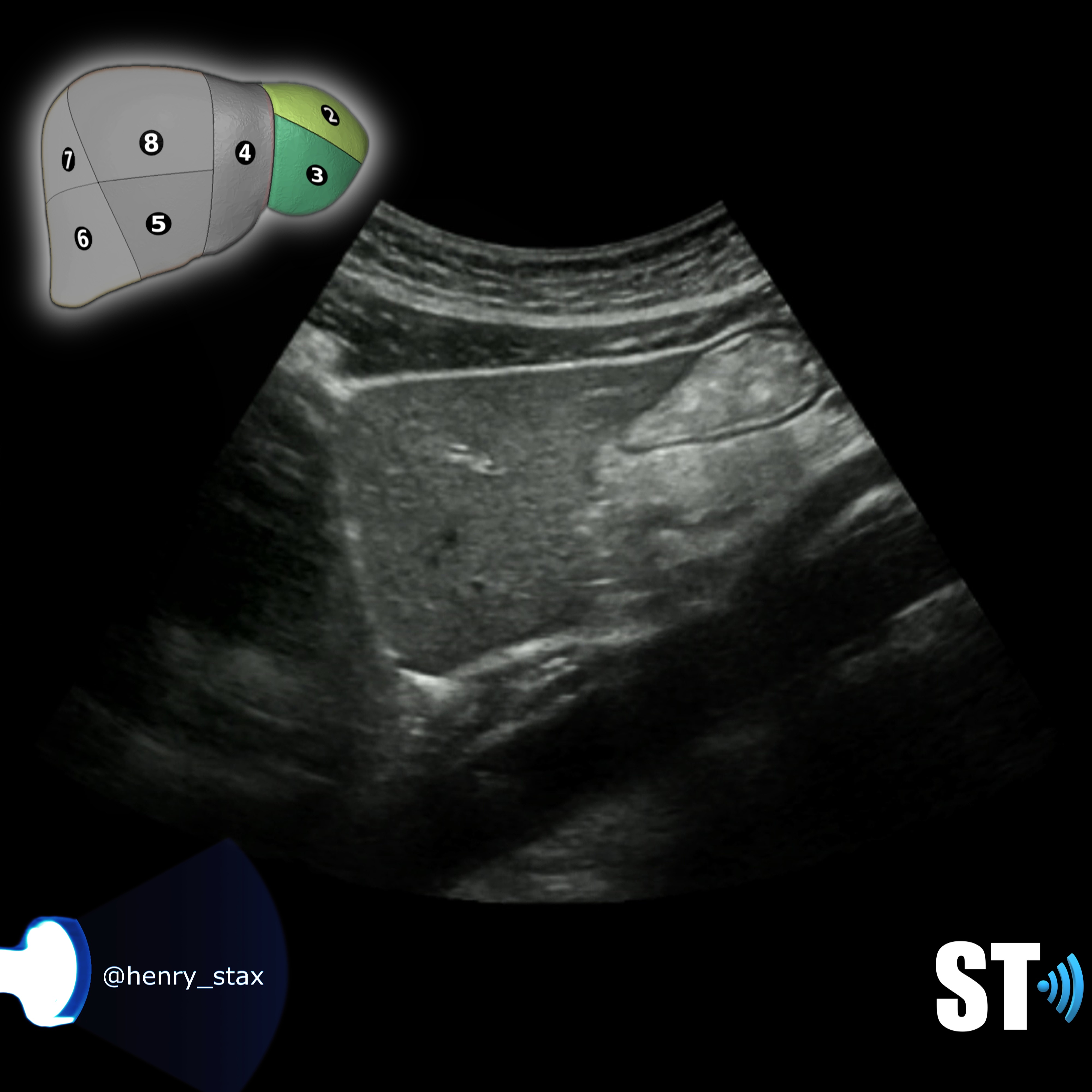 Couinaud’s Liver Segments – Sonographic Tendencies