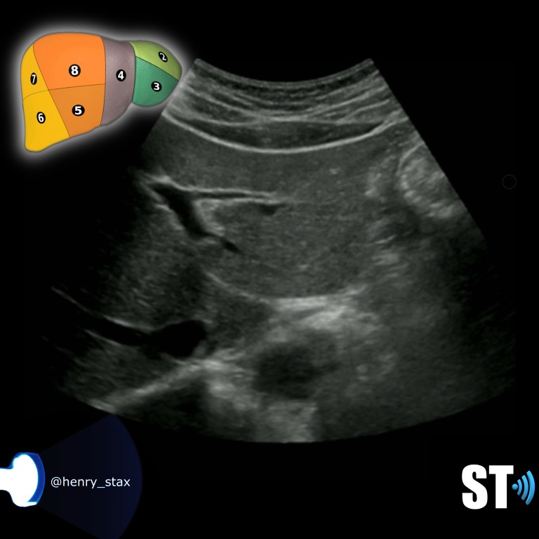Couinaud’s Liver Segments – Sonographic Tendencies