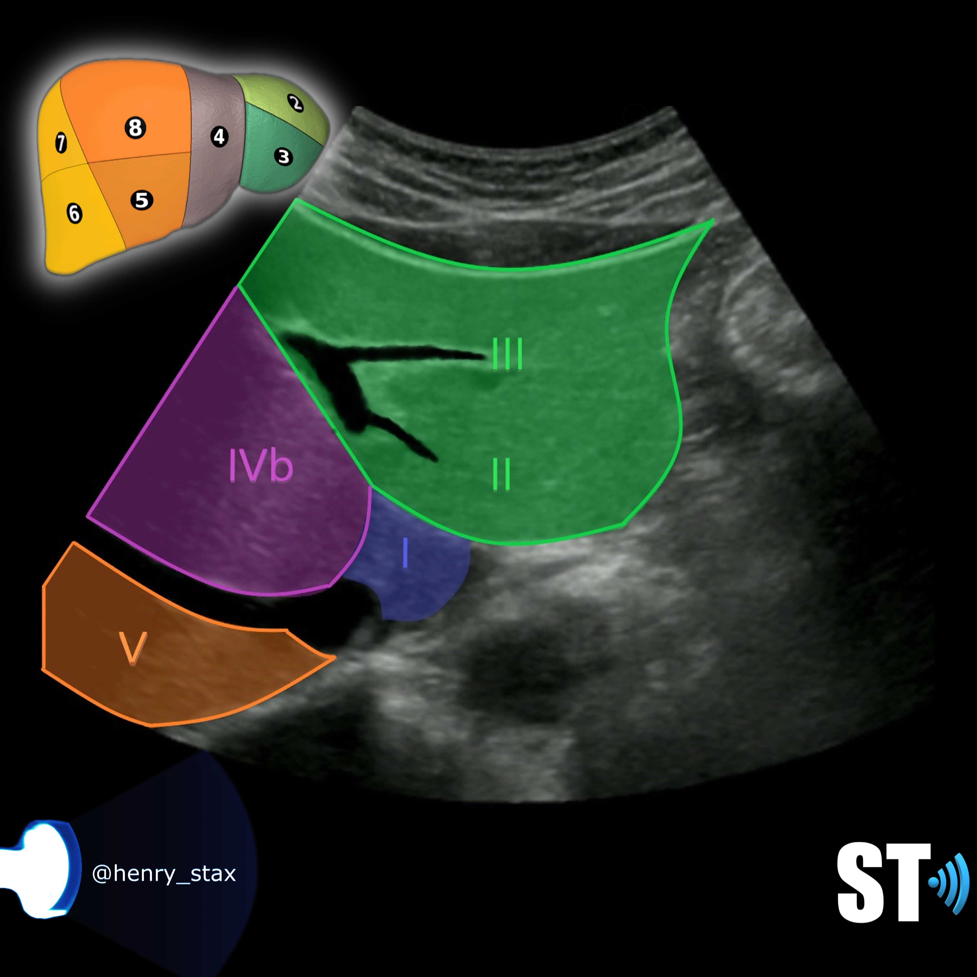 Couinaud’s Liver Segments – Sonographic Tendencies