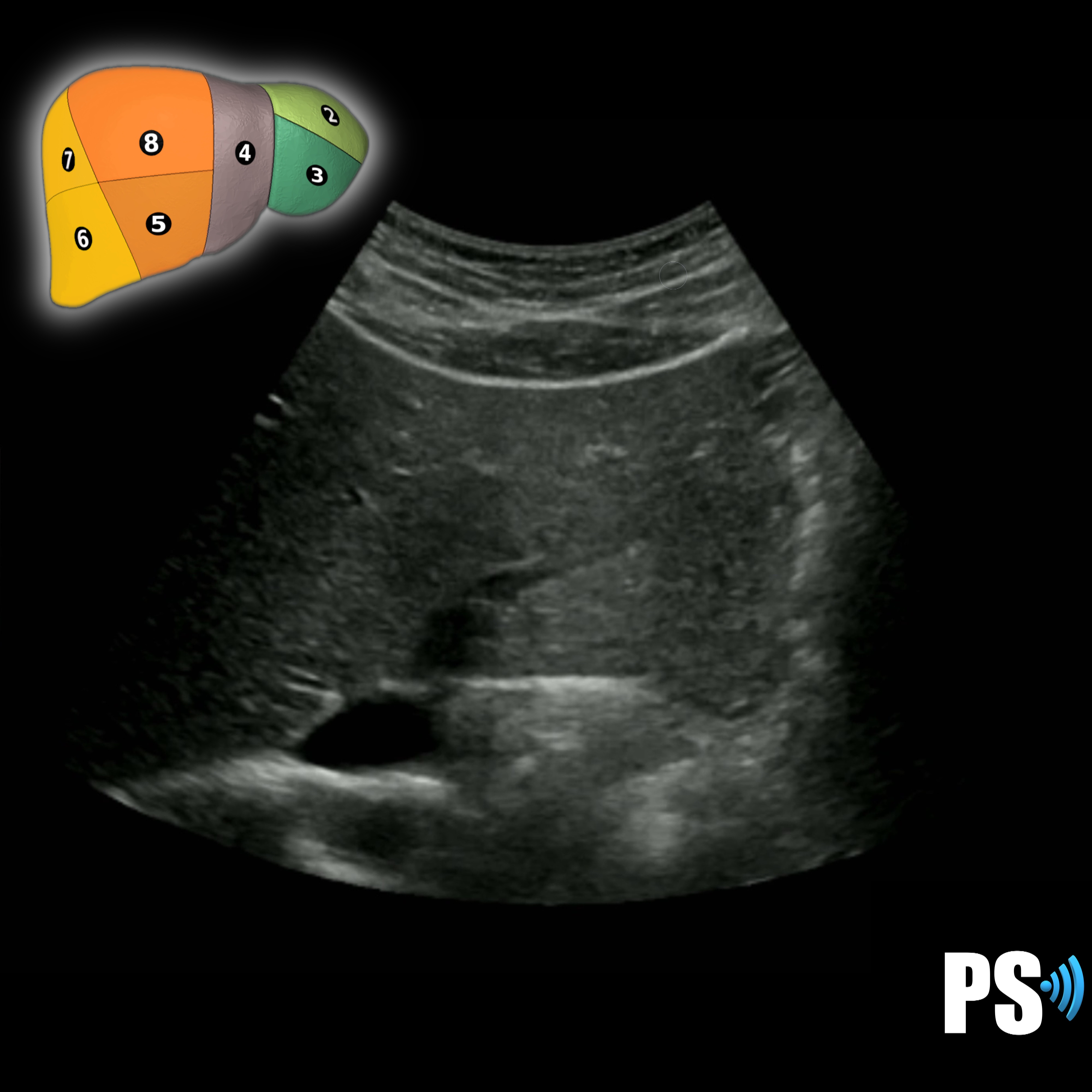 Couinaud’s Liver Segments – Sonographic Tendencies