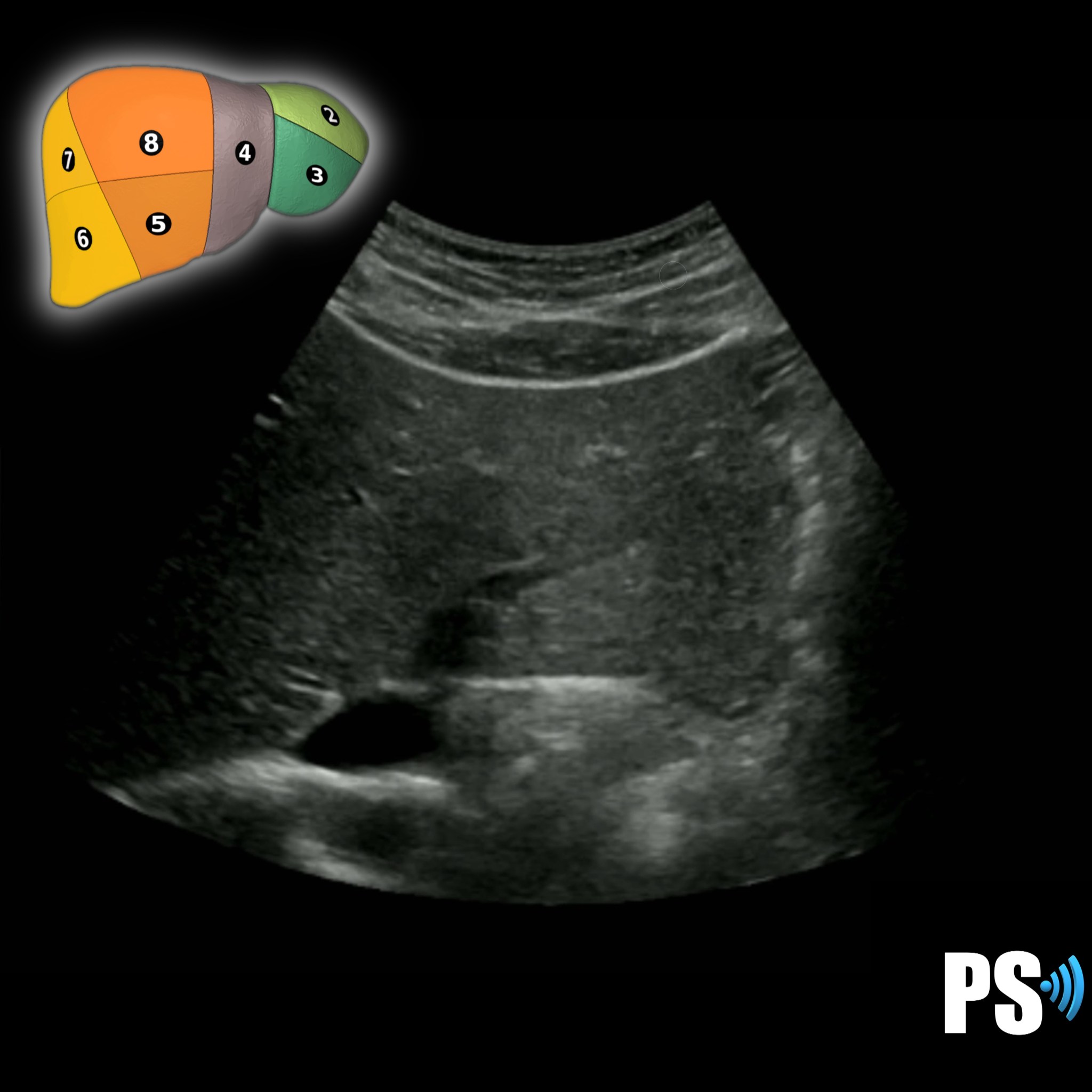 Couinaud’s Liver Segments – Sonographic Tendencies