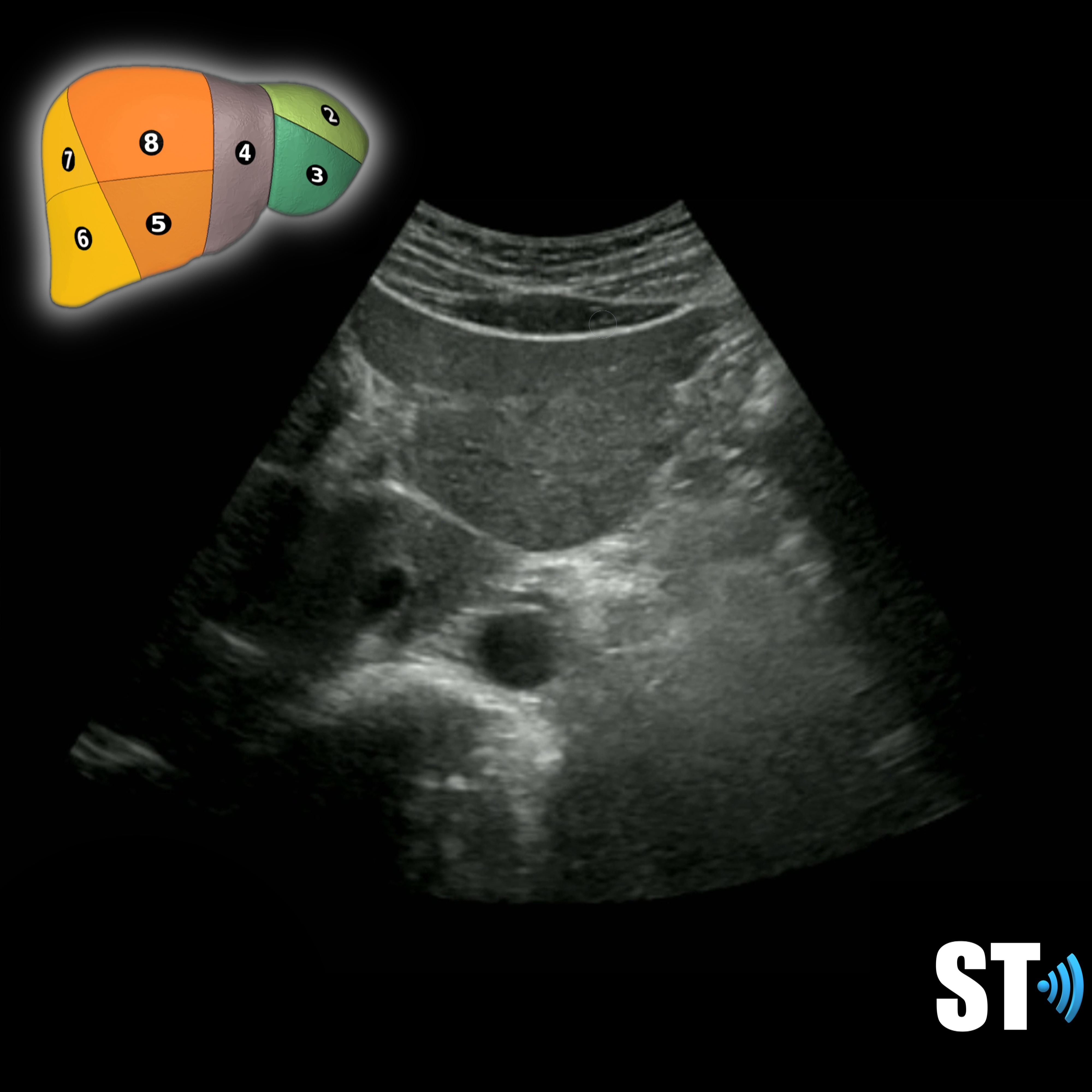 Couinaud’s Liver Segments – Sonographic Tendencies