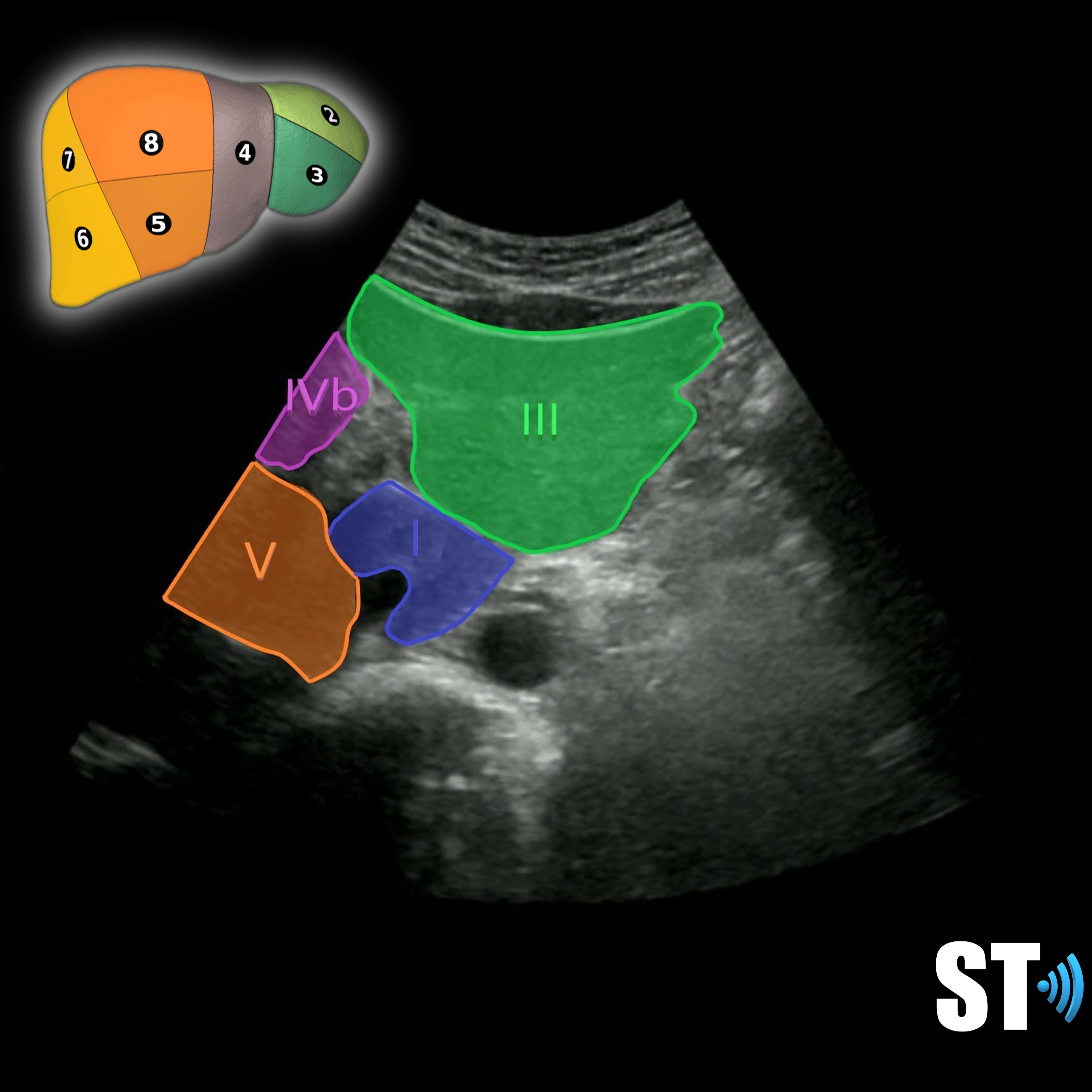Couinaud’s Liver Segments – Sonographic Tendencies