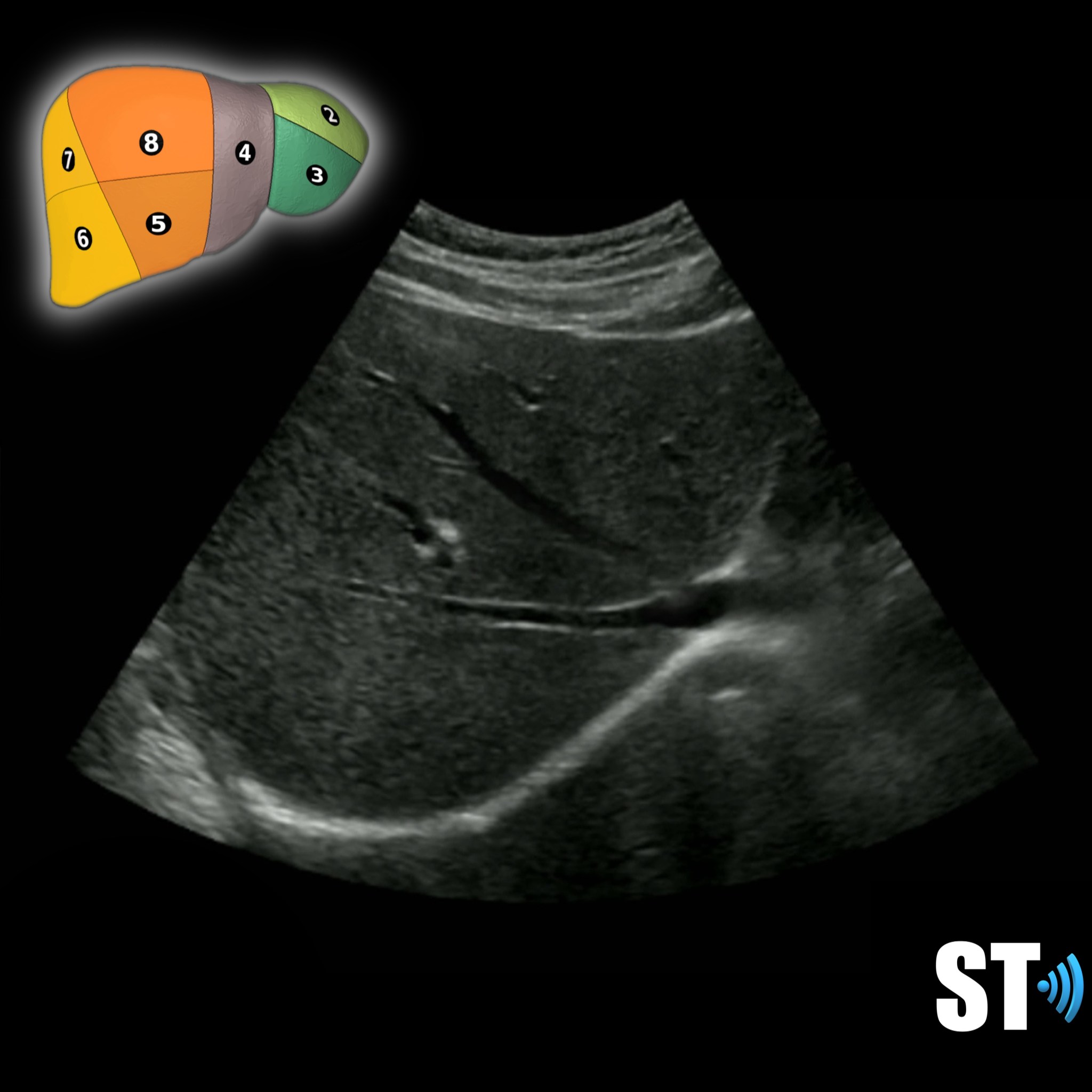 Couinaud’s Liver Segments – Sonographic Tendencies