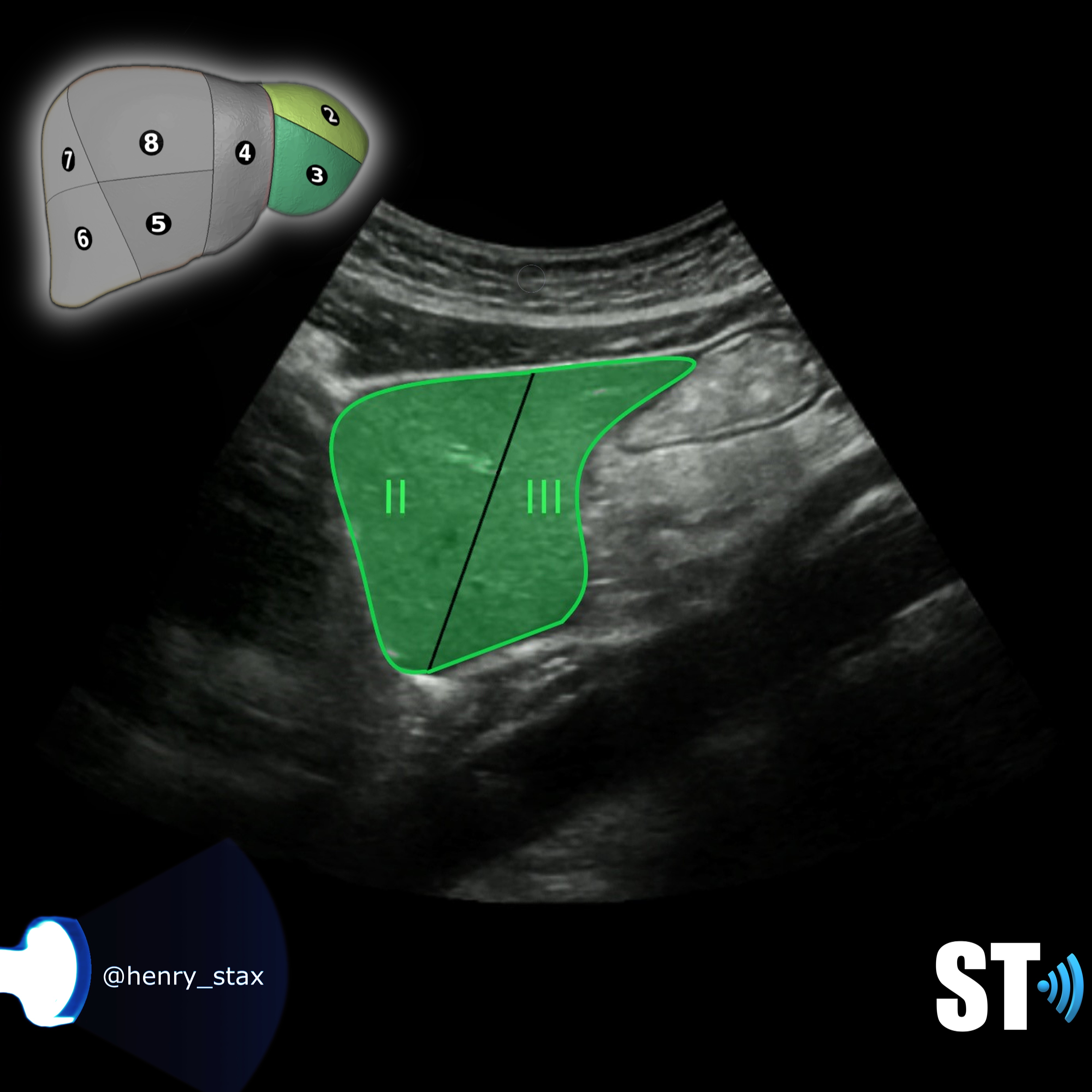 Couinaud’s Liver Segments – Sonographic Tendencies