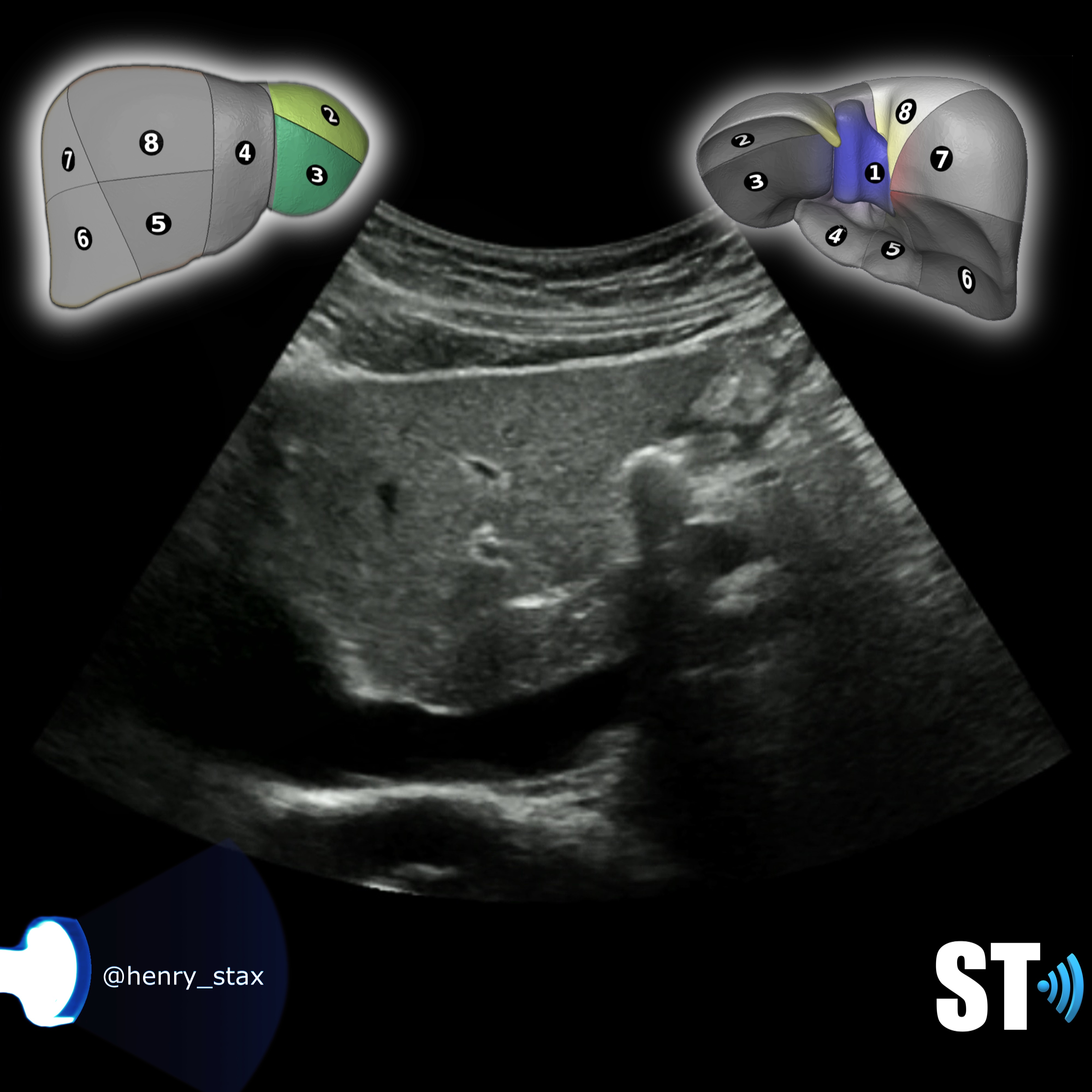 Couinaud’s Liver Segments – Sonographic Tendencies