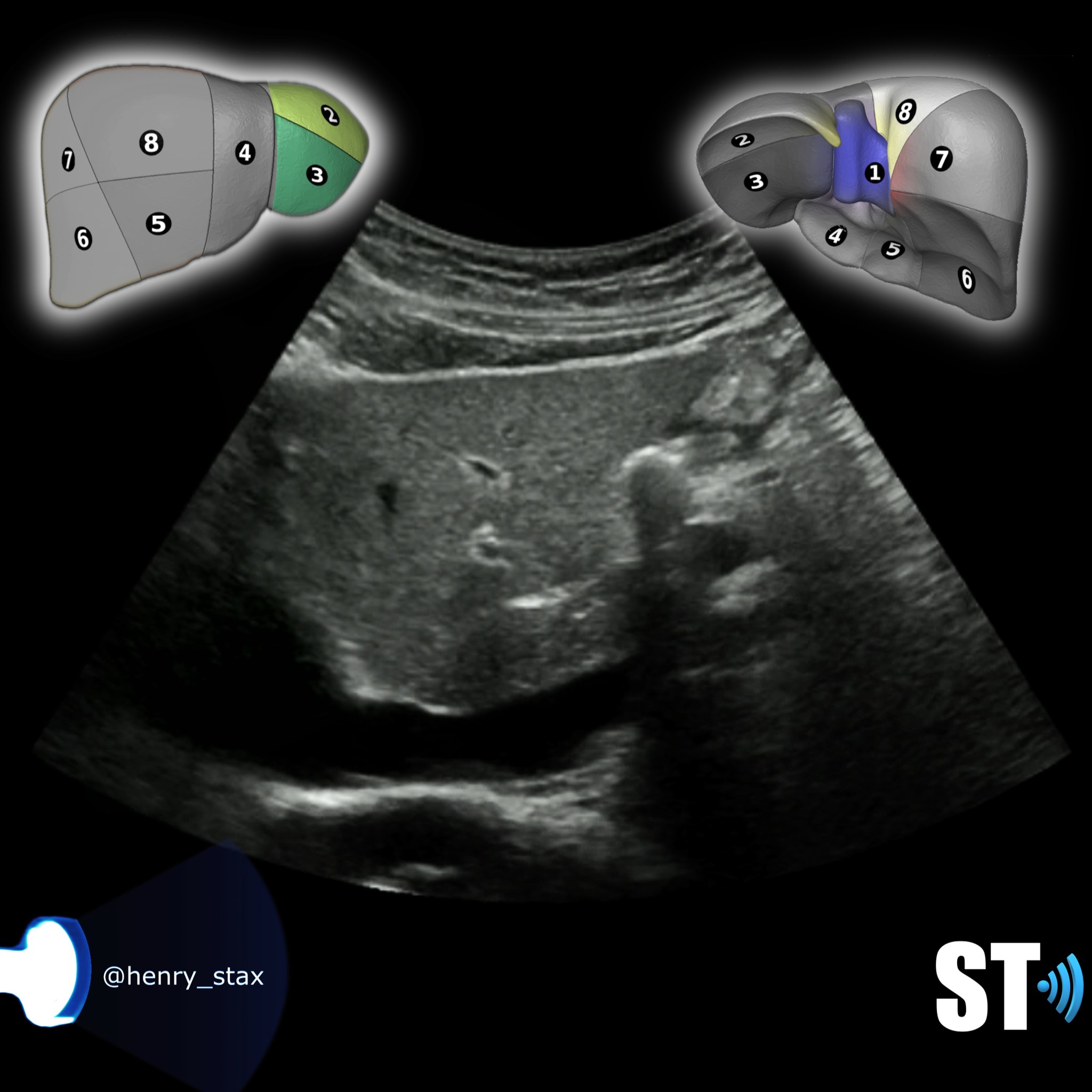 Couinaud’s Liver Segments – Sonographic Tendencies