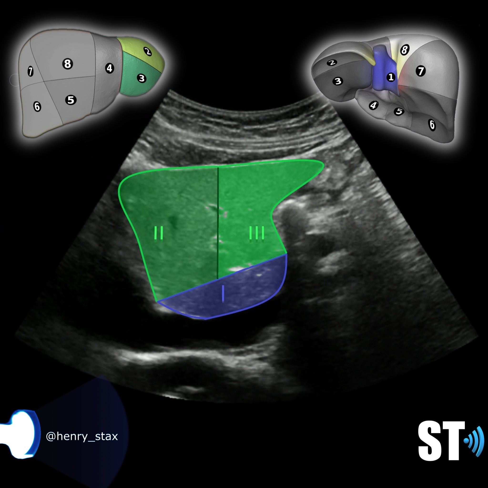 Couinaud’s Liver Segments – Sonographic Tendencies
