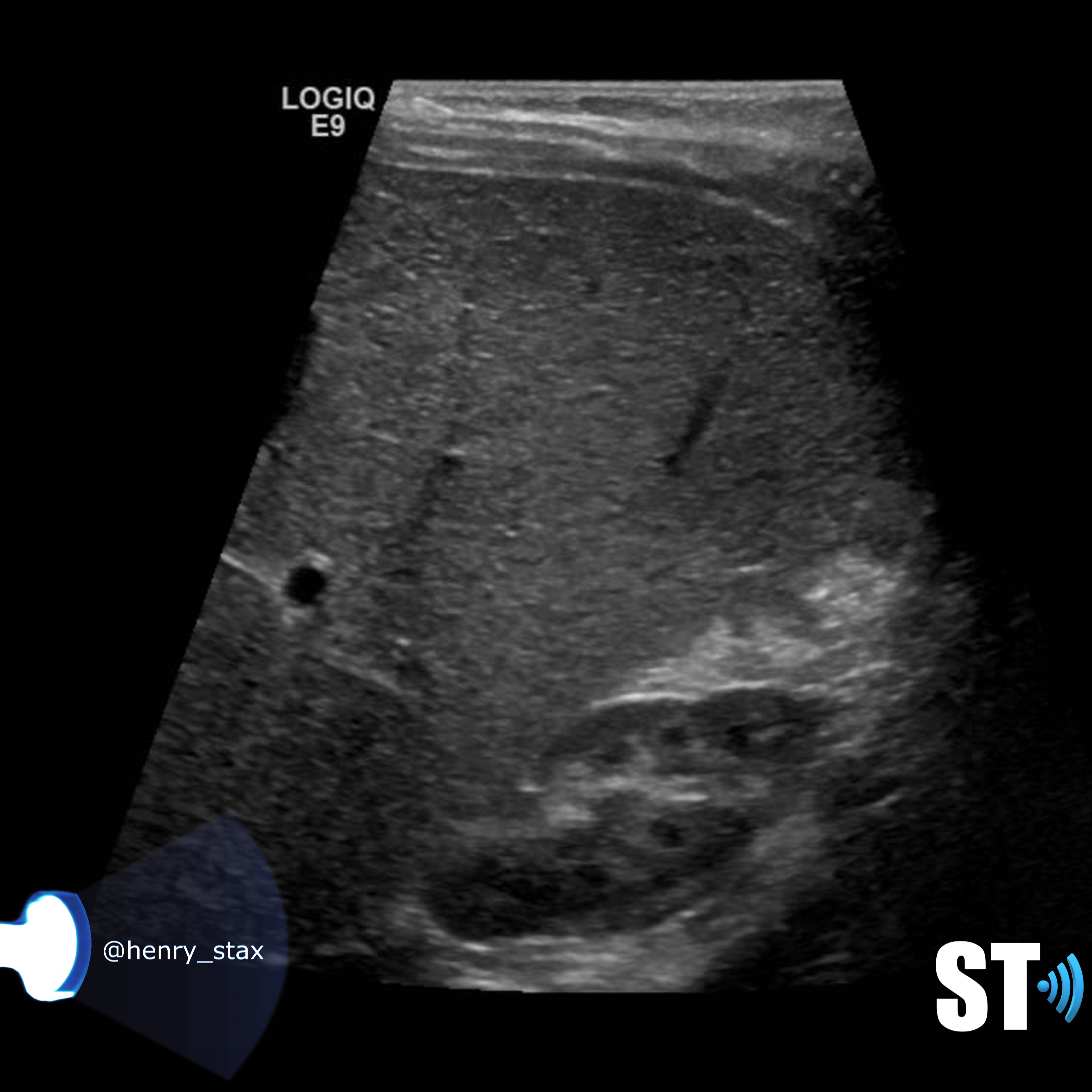 Renal Pathology – Sonographic Tendencies