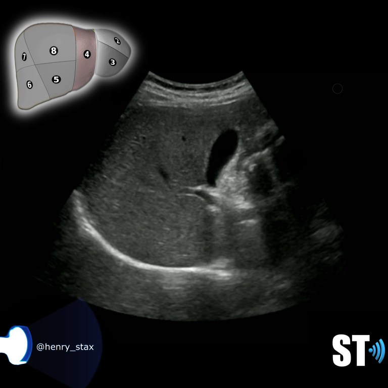 Couinaud’s Liver Segments – Sonographic Tendencies