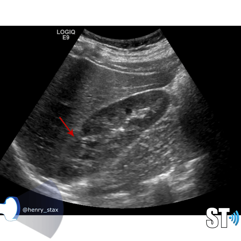 Renal Pathology – Sonographic Tendencies